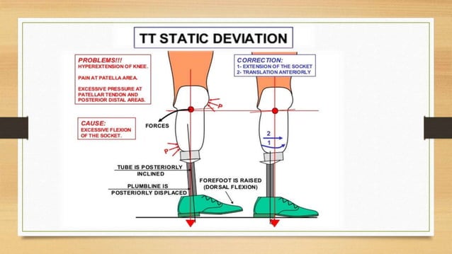 Alignment of Trans Tibial Prosthesis | PPTX