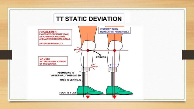Alignment of Trans Tibial Prosthesis | PPTX