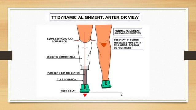 Alignment of Trans Tibial Prosthesis | PPTX