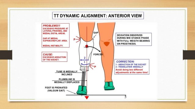 Alignment of Trans Tibial Prosthesis | PPTX