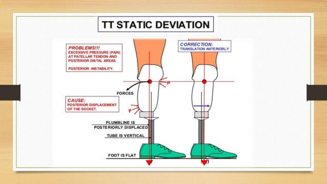 Alignment of Trans Tibial Prosthesis