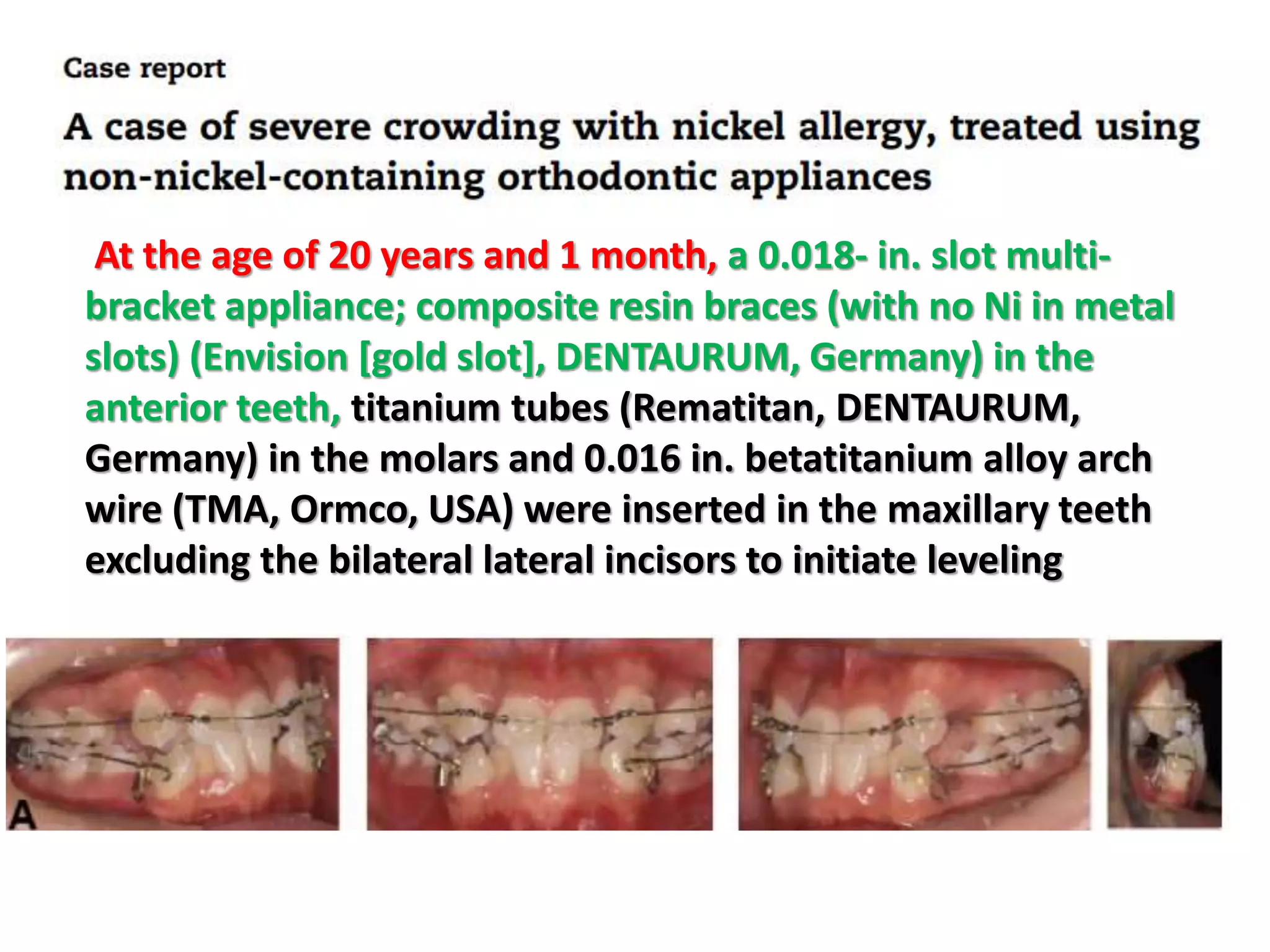 orthodontic alignment of teeth part 3 | PPTX