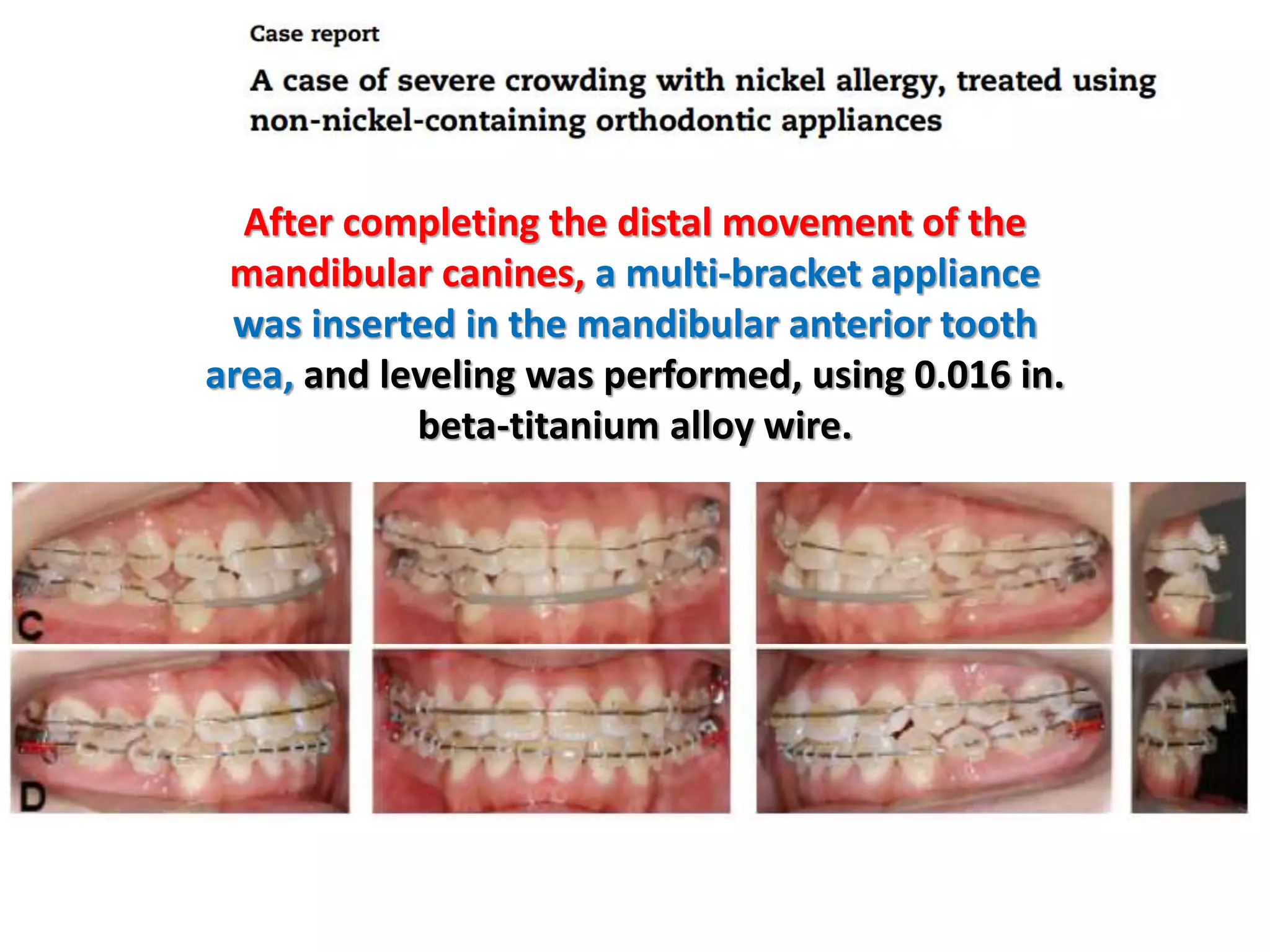 orthodontic alignment of teeth part 3 | PPTX