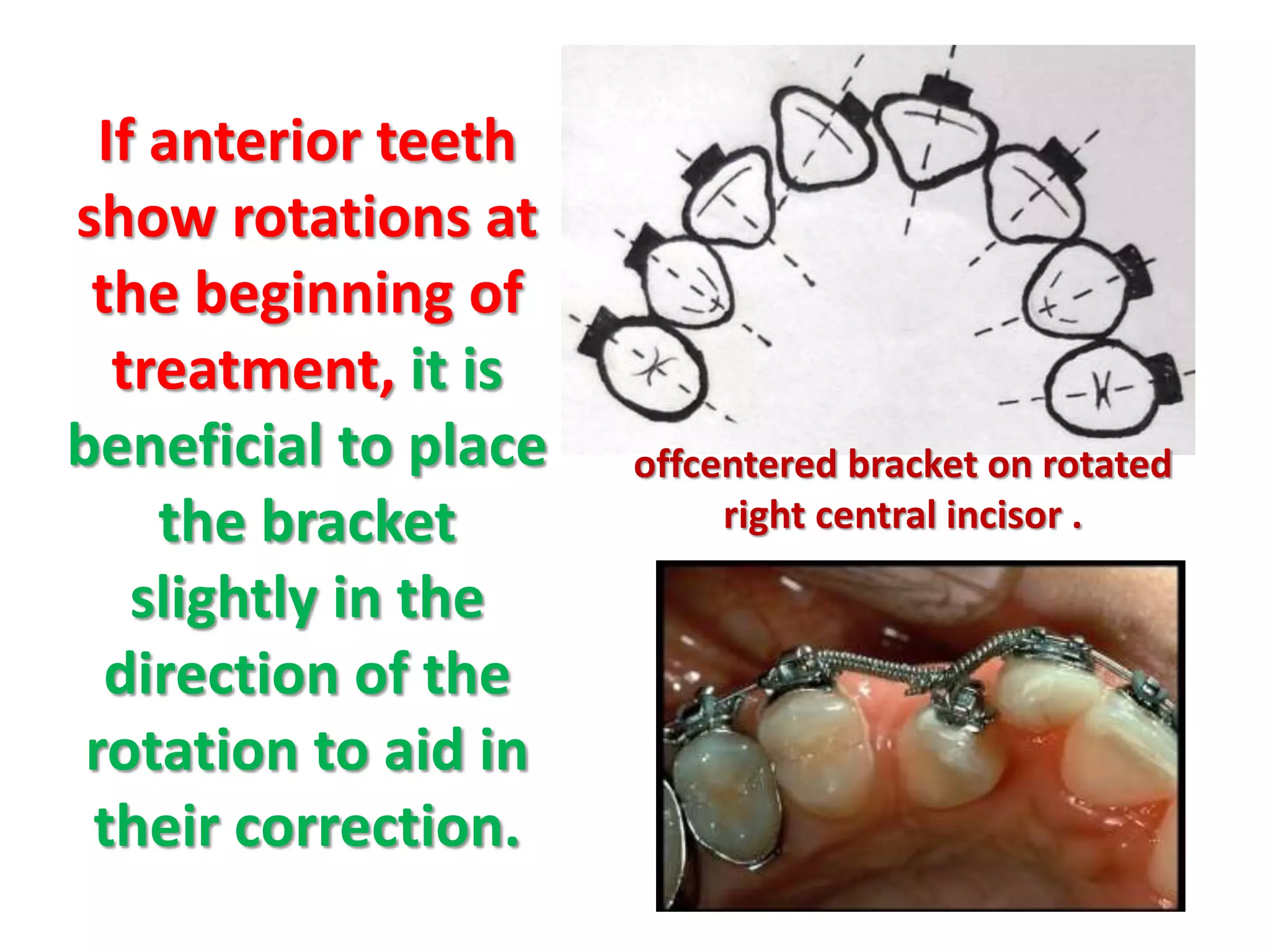 orthodontic alignment of teeth part 3 | PPTX