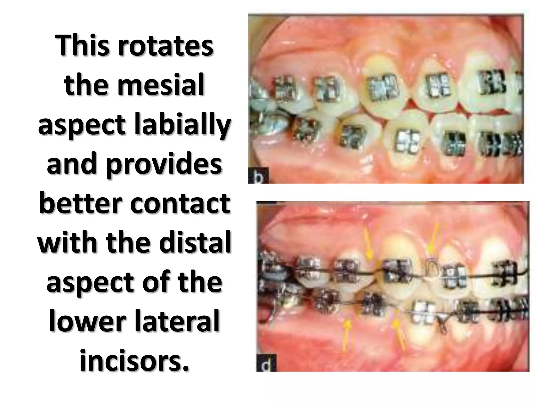 orthodontic alignment of teeth part 3 | PPTX