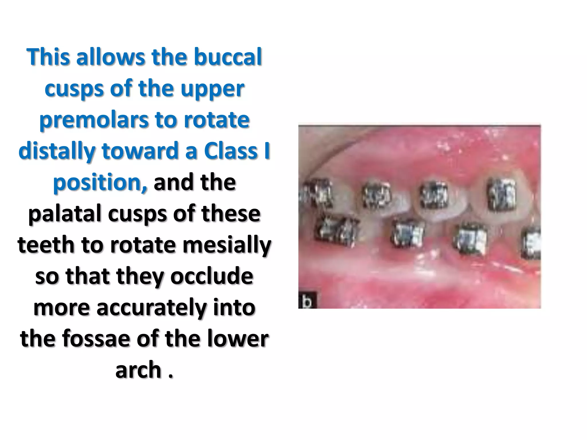 orthodontic alignment of teeth part 3 | PPTX