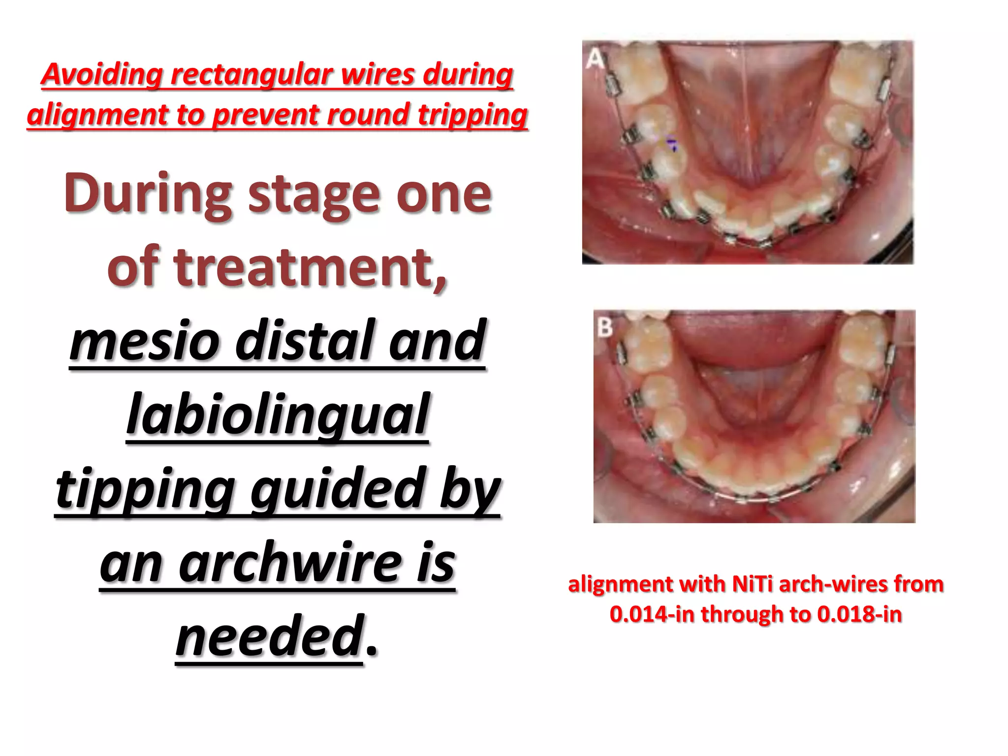 orthodontic alignment of teeth part 3 | PPTX