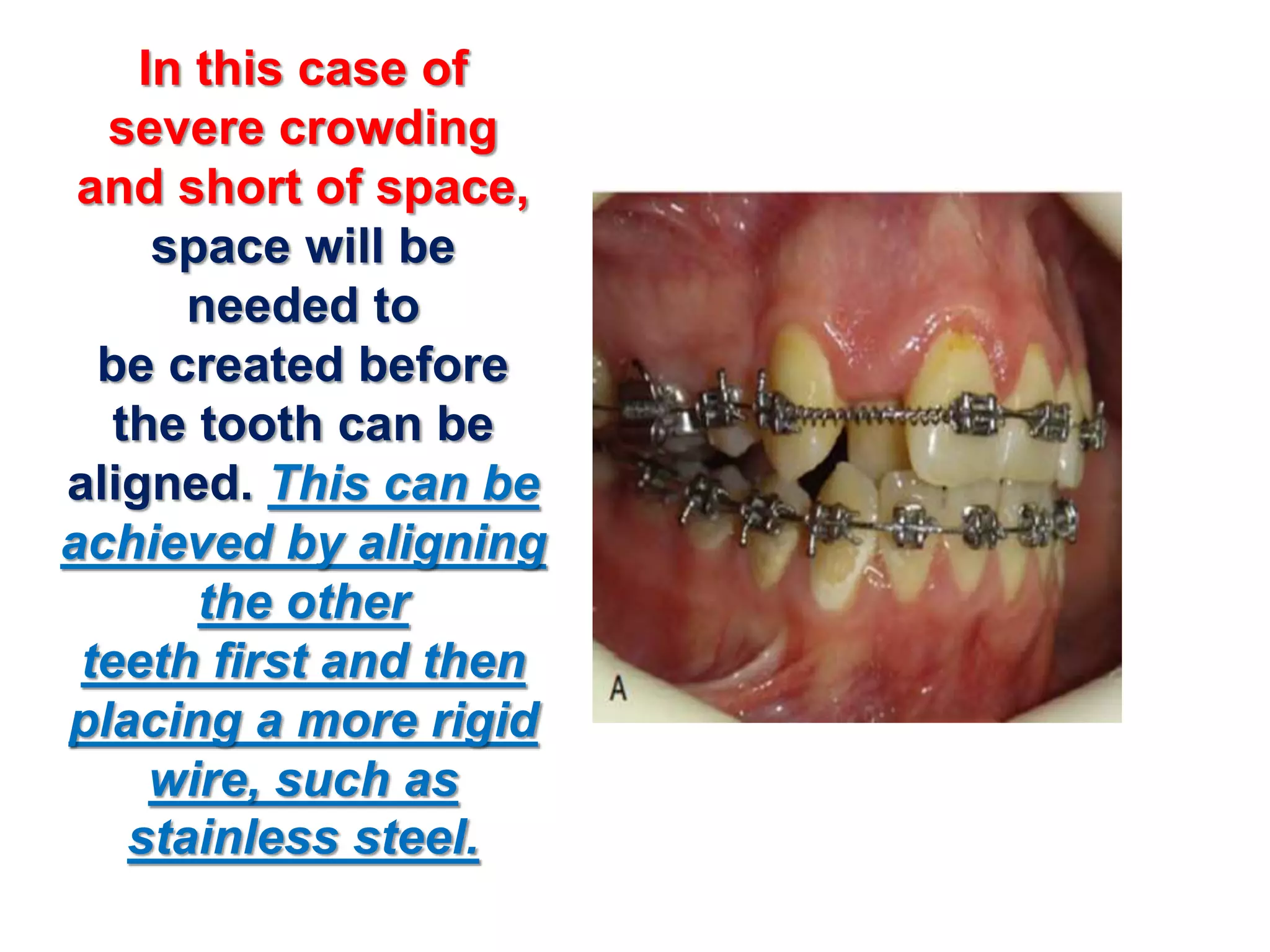 orthodontic alignment of teeth part 3 | PPTX
