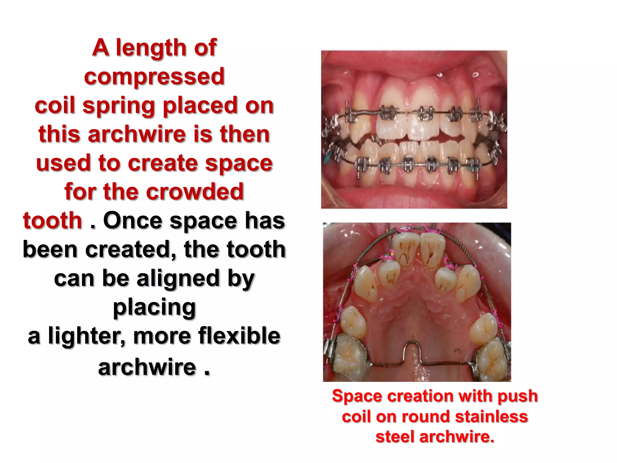 orthodontic alignment of teeth part 3 | PPTX