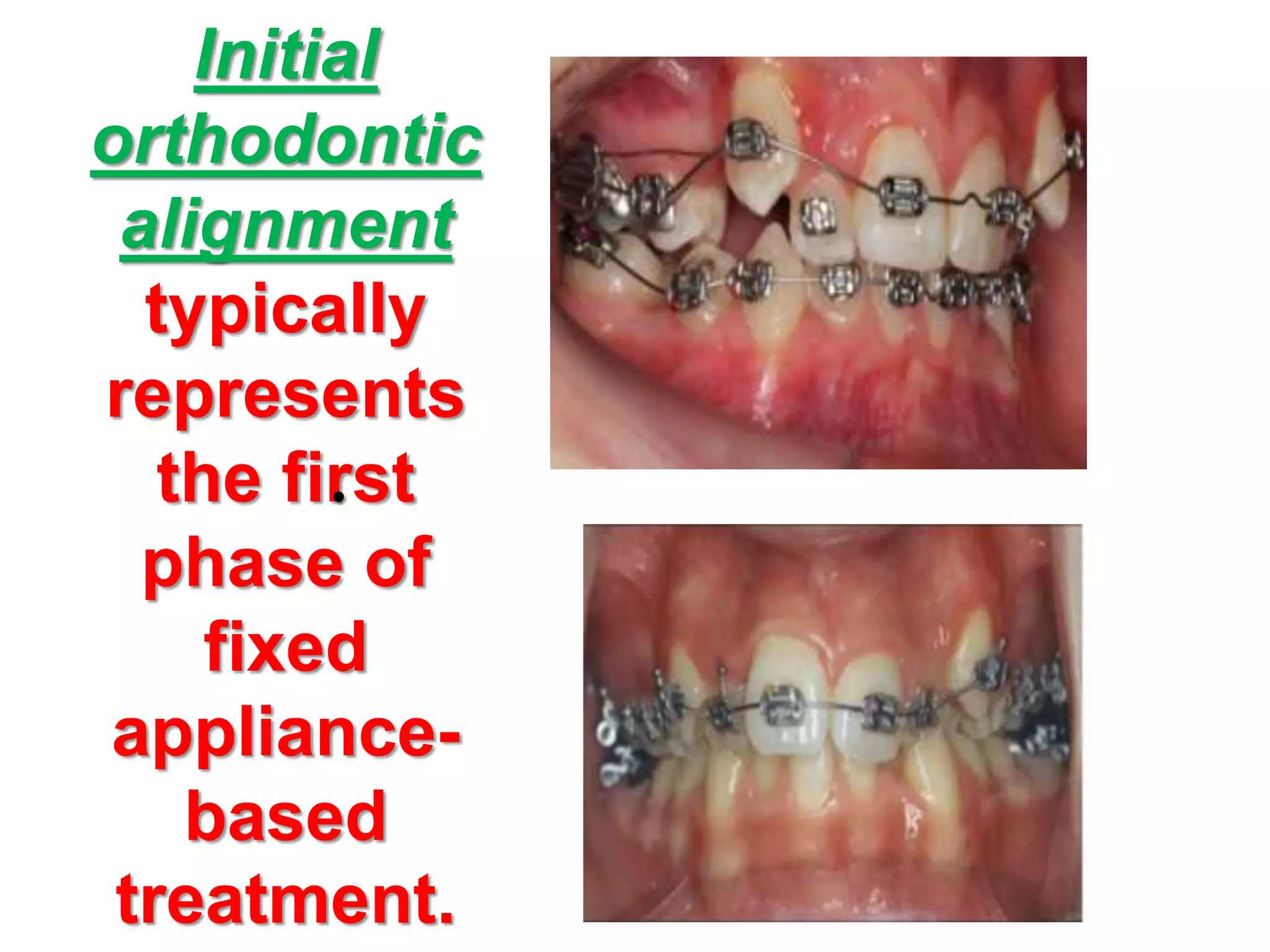 orthodontic alignment of teeth part 3 | PPTX