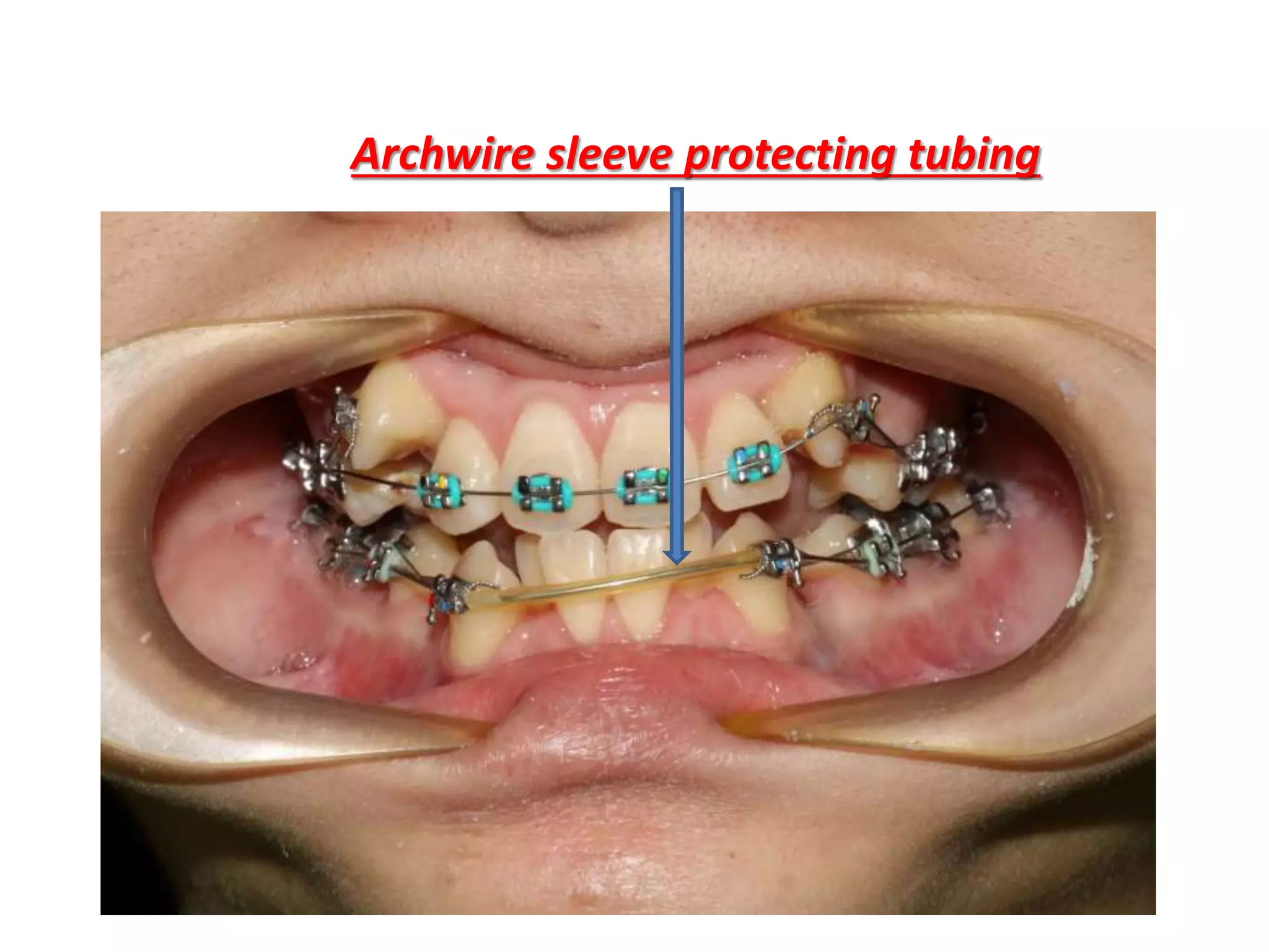 orthodontic alignment of teeth part 3 | PPTX