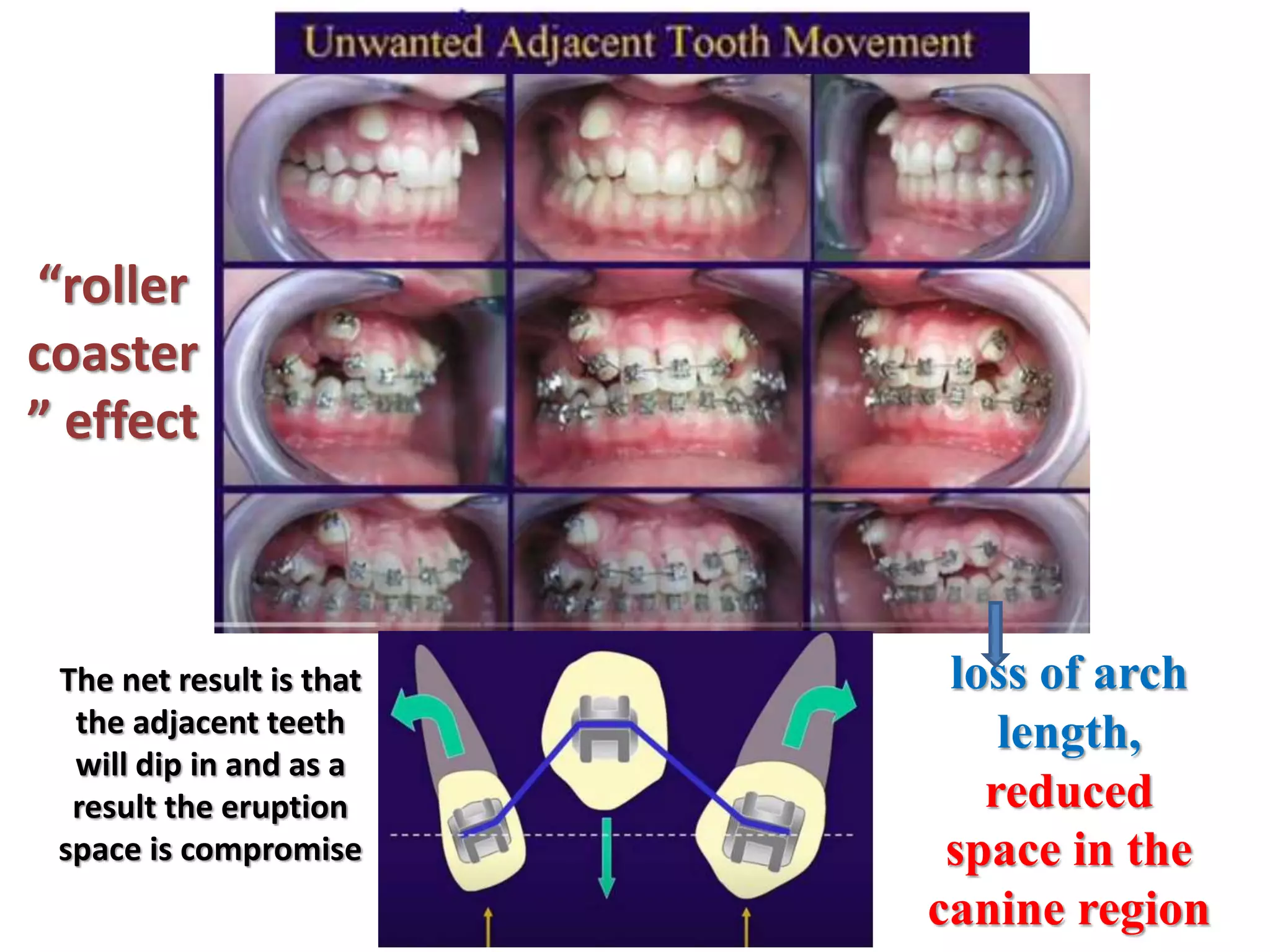 orthodontic alignment of teeth part 3 | PPTX