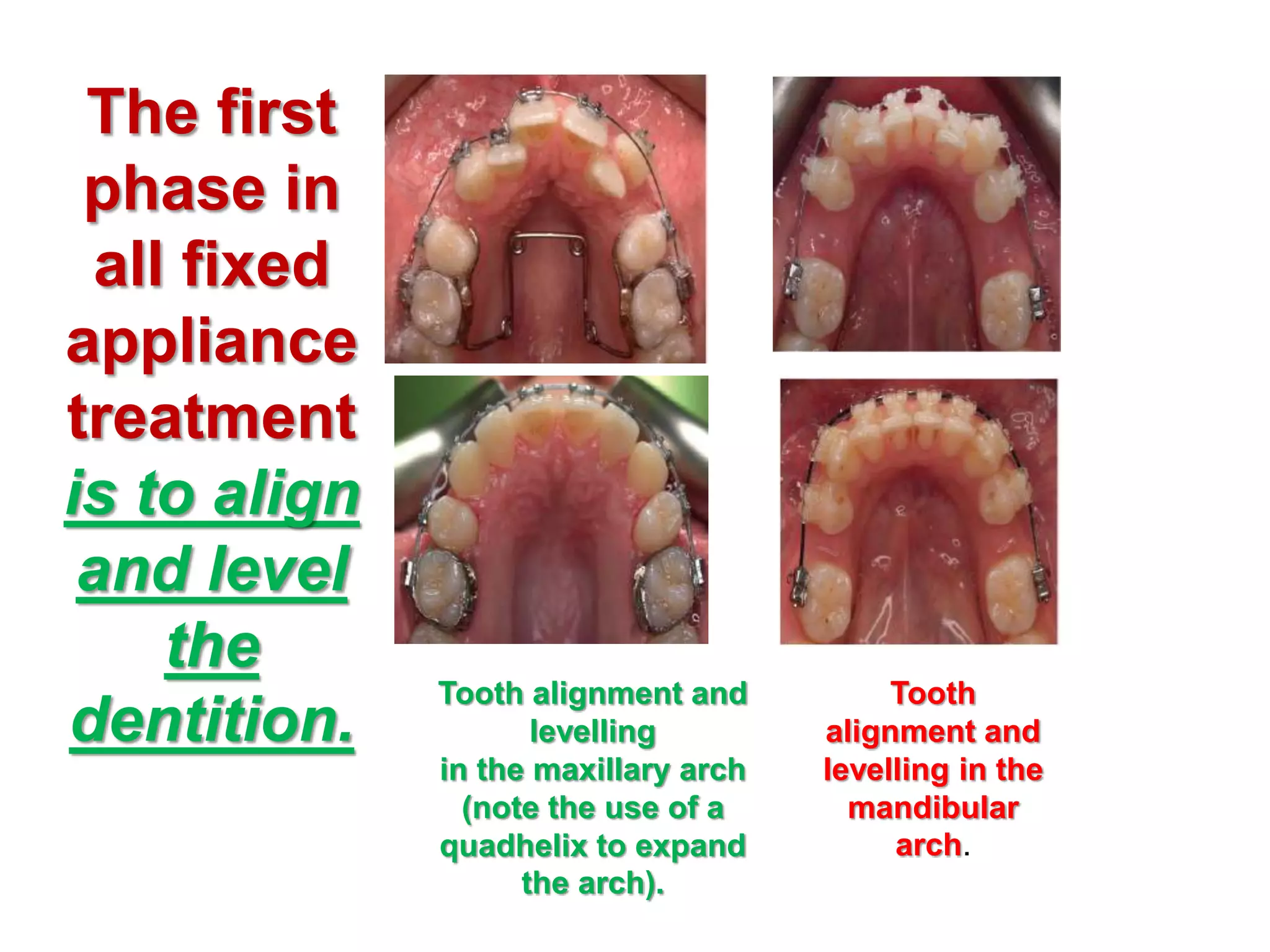 orthodontic alignment of teeth part 3 | PPTX