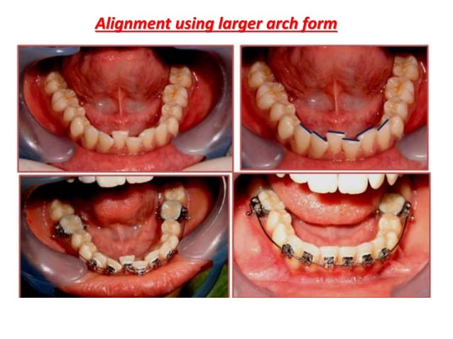 orthodontic alignment of teeth part 3 | PPTX