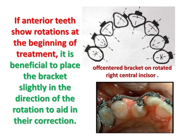 orthodontic alignment of teeth part 3 | PPTX