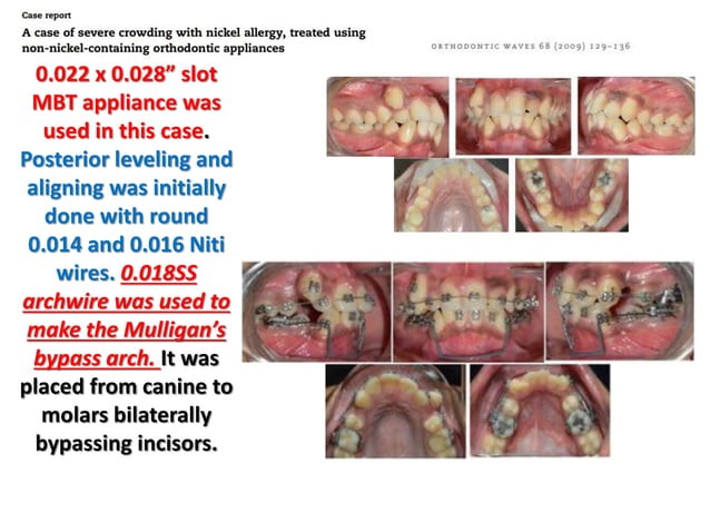 orthodontic alignment of teeth part 3 | PPTX