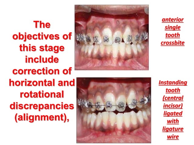 orthodontic alignment of teeth part 3 | PPTX