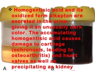 Alkaptonuria | PPT