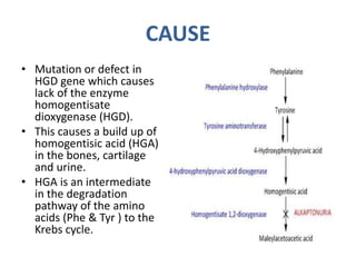 Alkaptonuria | PPTX