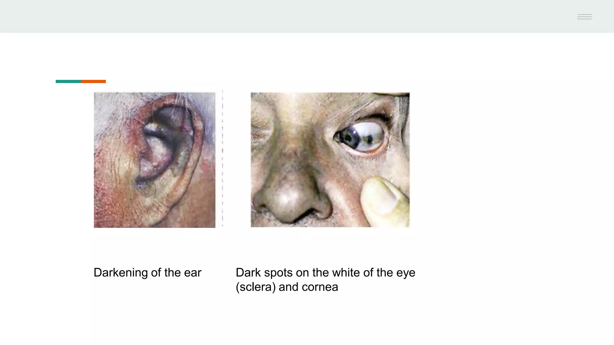 Alkaptonuria | PPTX