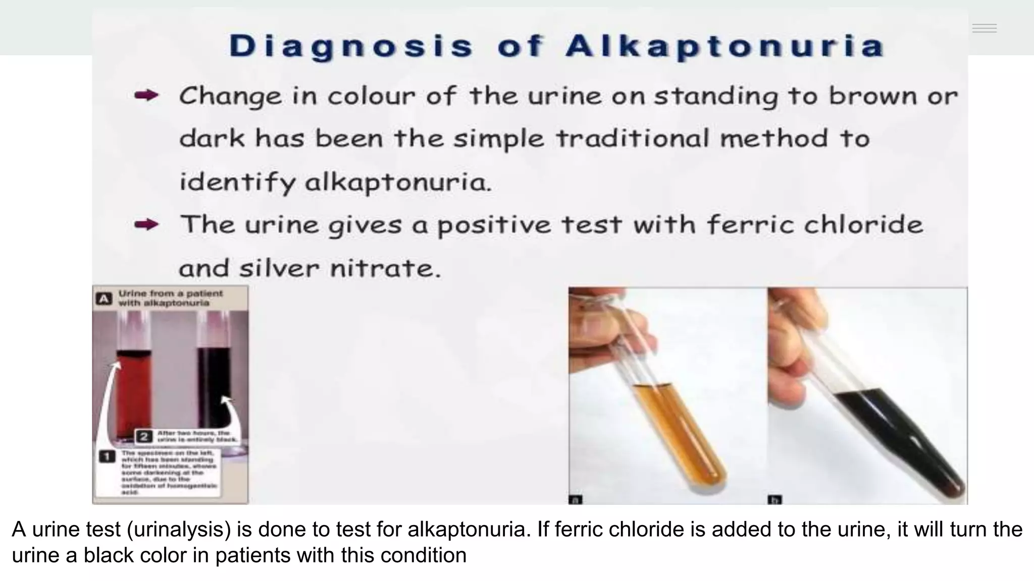 Alkaptonuria | PPTX