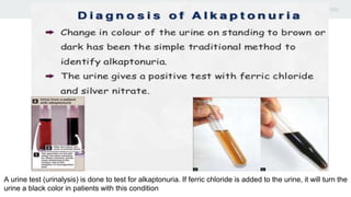 Alkaptonuria | PPTX