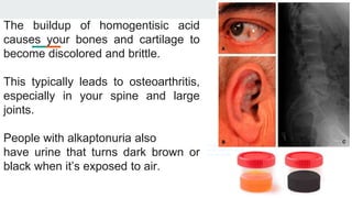 Alkaptonuria | PPTX