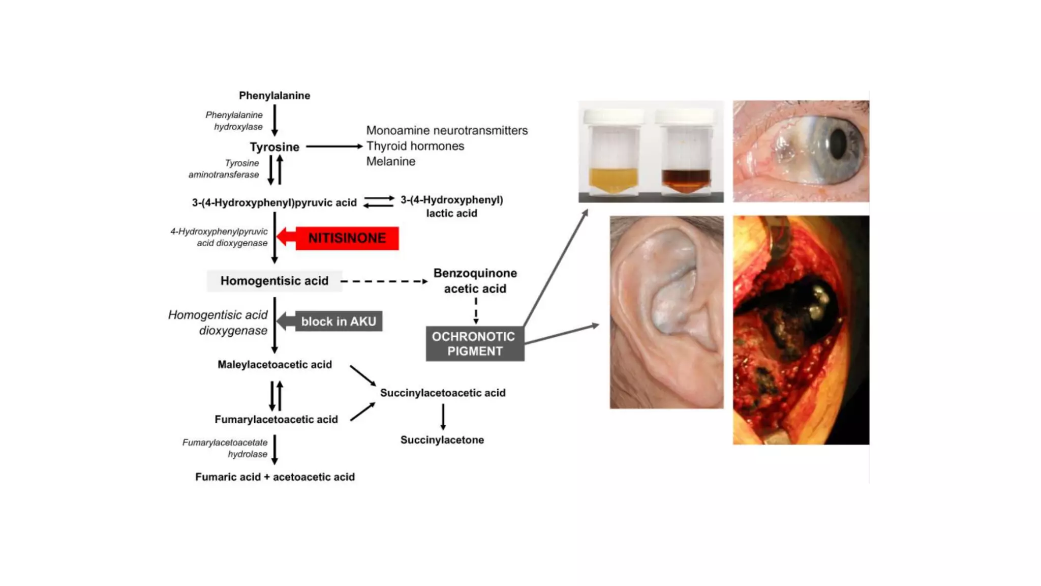 Alkaptonuria | PPT