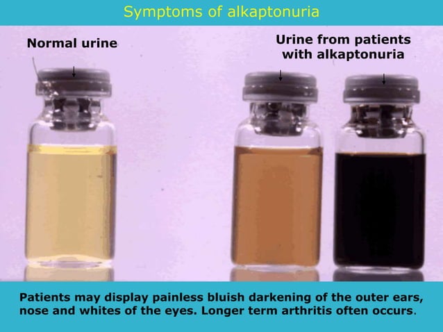 alkaptonuria a rare disease also called as black urine disease | PPT