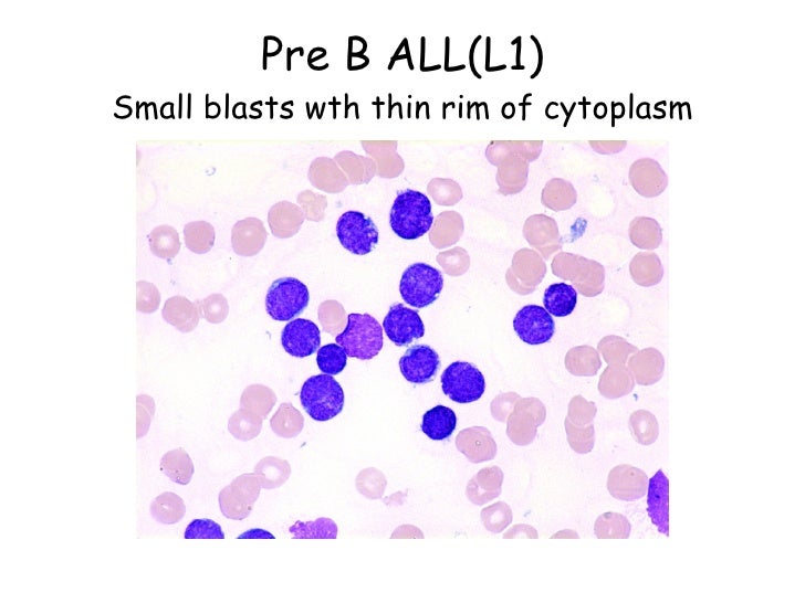 Acute Lymphoblastic Leukaemia