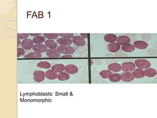 Acute lymphoblastic leukemia approach and treatment | PPTX