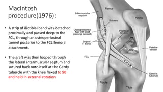 ALL (antero-lateral ligament) - extra articular ACL reconstruction ...