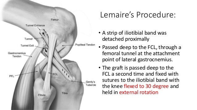 ALL (antero-lateral ligament) - extra articular ACL reconstruction