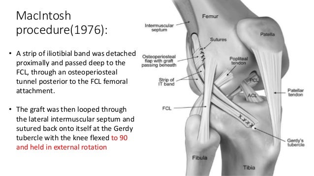 ALL (antero-lateral ligament) - extra articular ACL reconstruction