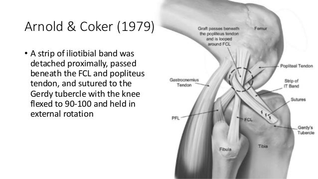 ALL (antero-lateral ligament) - extra articular ACL reconstruction