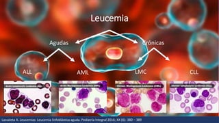 Leucemia linfoblástica aguda | PPTX