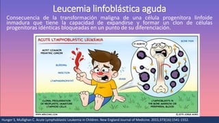 Leucemia linfoblástica aguda | PPTX