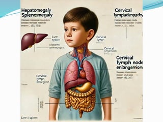 A presentation on Pathology acute lymphocytic leukemia | PPTX