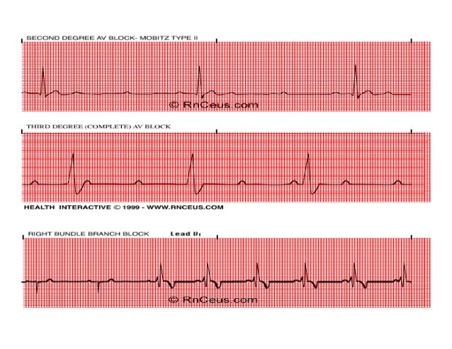 All About ECG