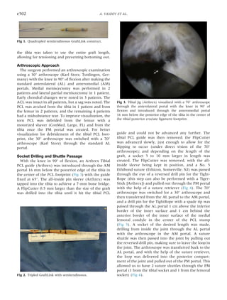 All inside posterior cruciate ligament killer turm | PDF