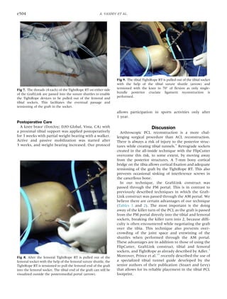 All inside posterior cruciate ligament killer turm | PDF