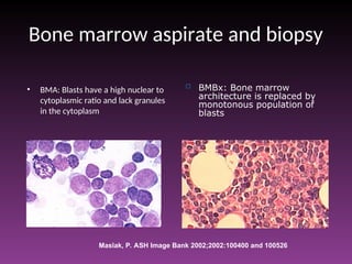 Acute Lymphocytic Leukemia ( ALL ) , ,,,, | PPT