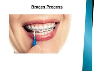 All About Braces - Vyom Dental Care | PPT