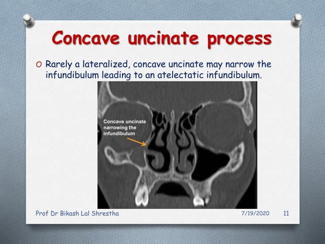 All about uncinate process of nose and paranasal sinuses | PPTX
