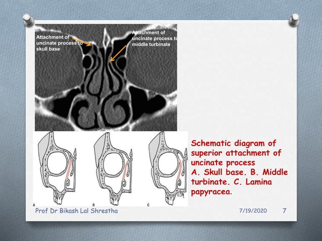 All about uncinate process of nose and paranasal sinuses | PPTX