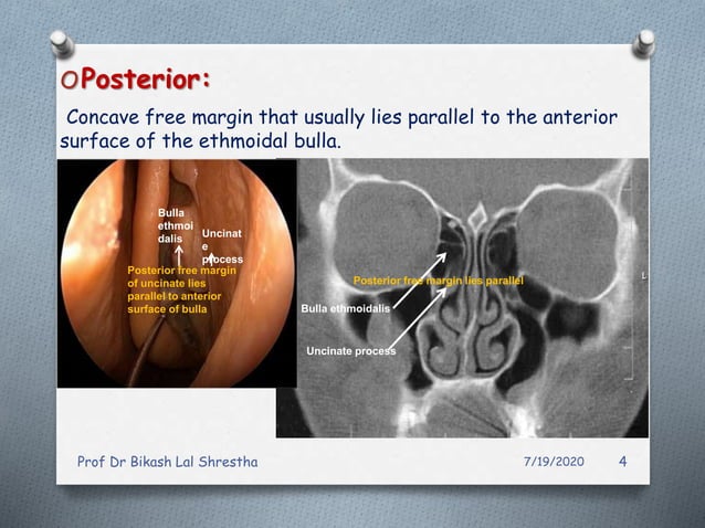 All about uncinate process of nose and paranasal sinuses