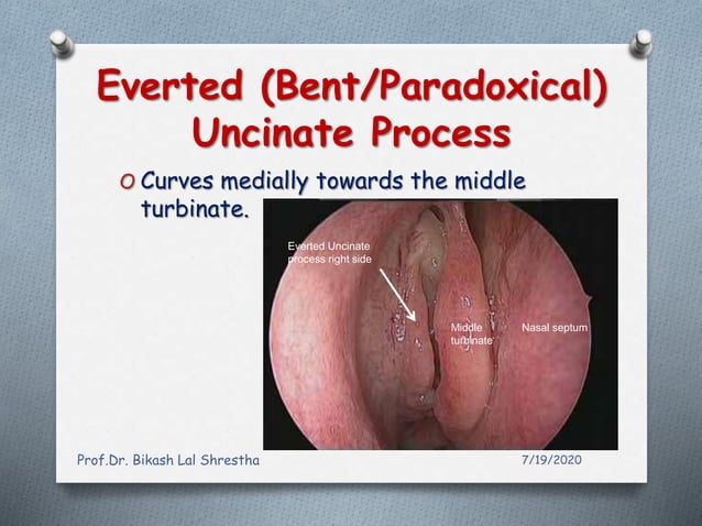 All about uncinate process of nose and paranasal sinuses