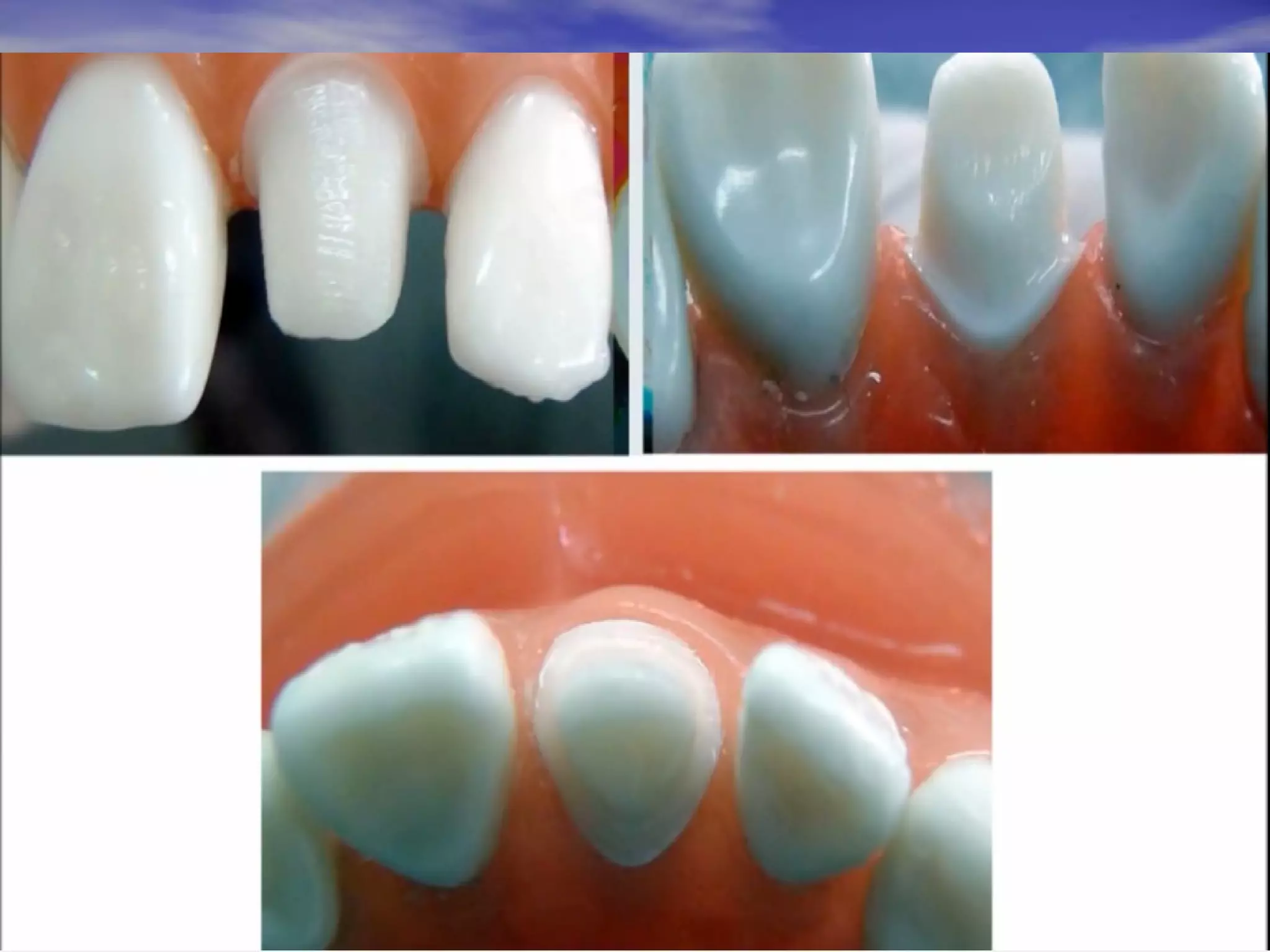 All ceramic crown preparation seminar | PPT