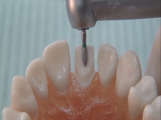 All ceramic crown preparation seminar | PPT