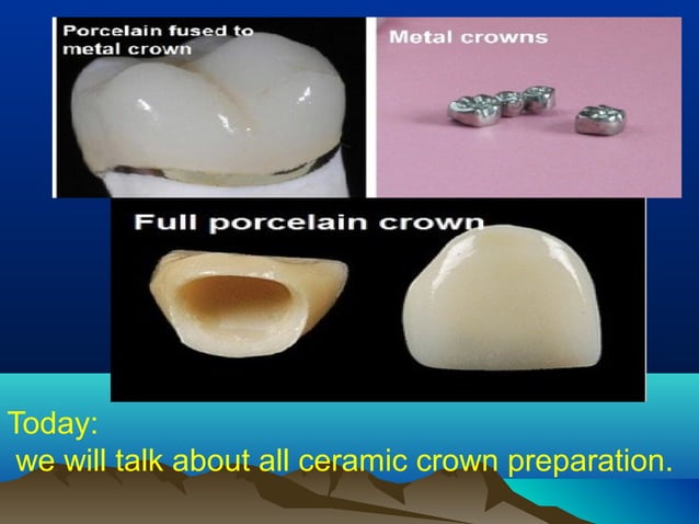 All ceramic crown preparation seminar | PPT